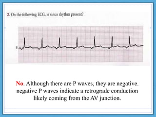 Normal ecg interpretation | PPTX