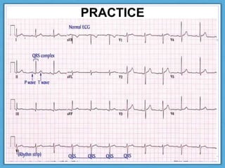 Normal Ecg