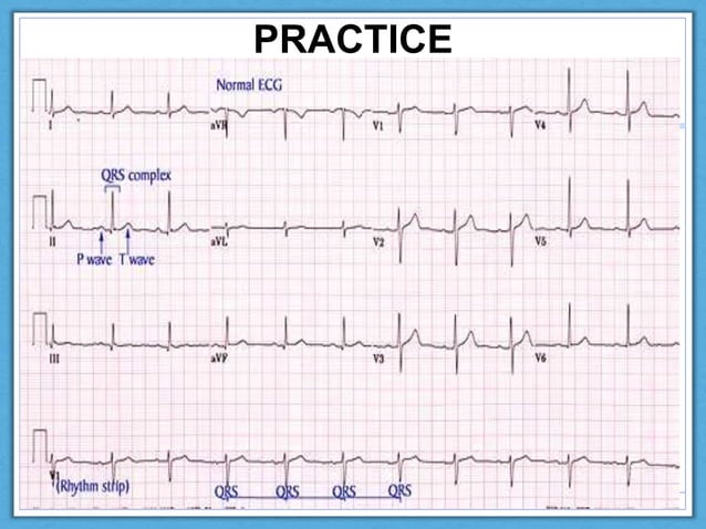 Normal ecg interpretation