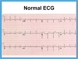 Normal Ecg