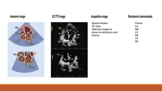 Normal Echocardiogram. Based on cardiac studies | PDF