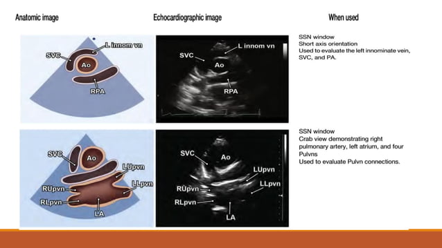 Normal Echocardiogram. Based on cardiac studies | PDF