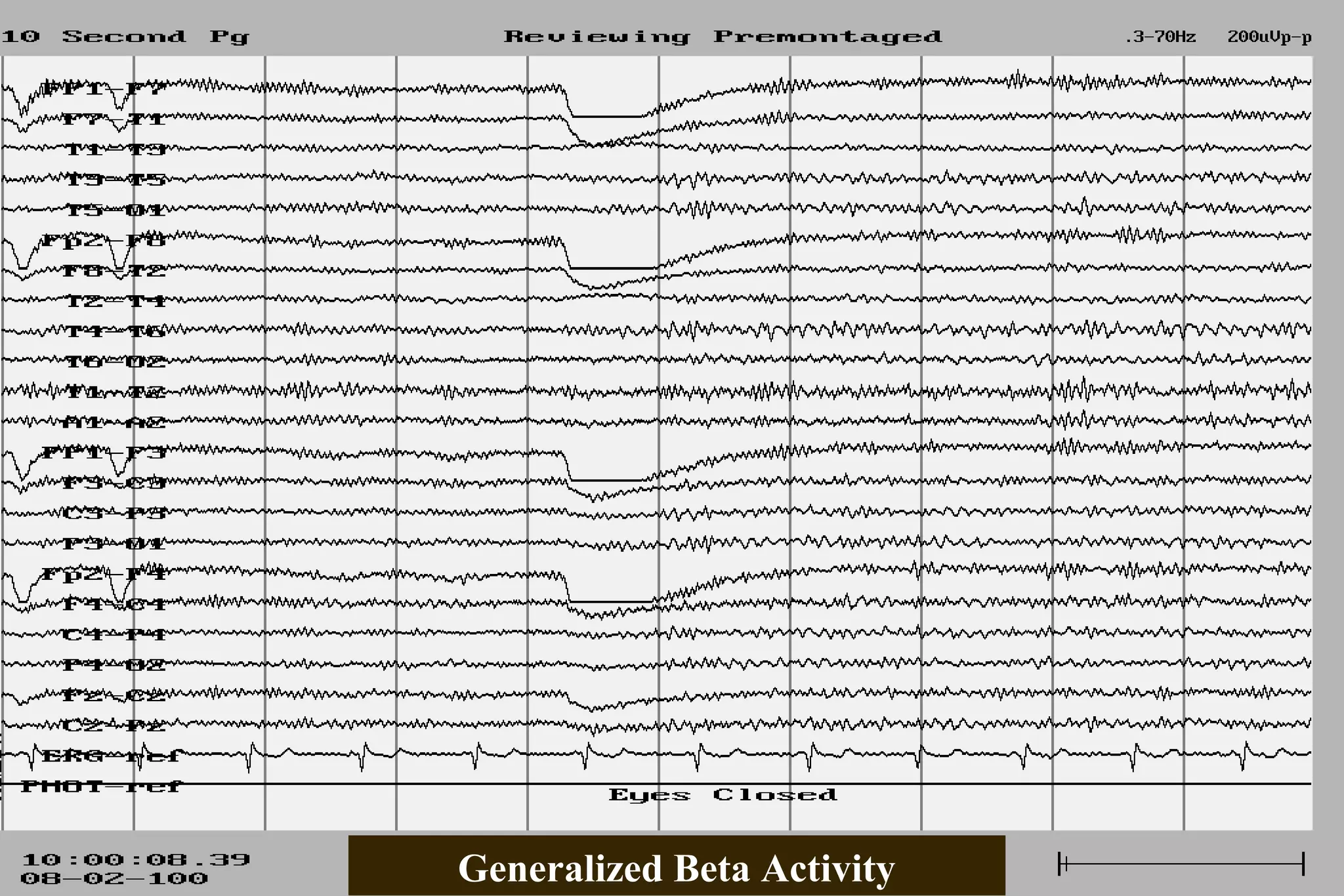 Normal EEG patterns, frequencies, as well as patterns that may simulate ...