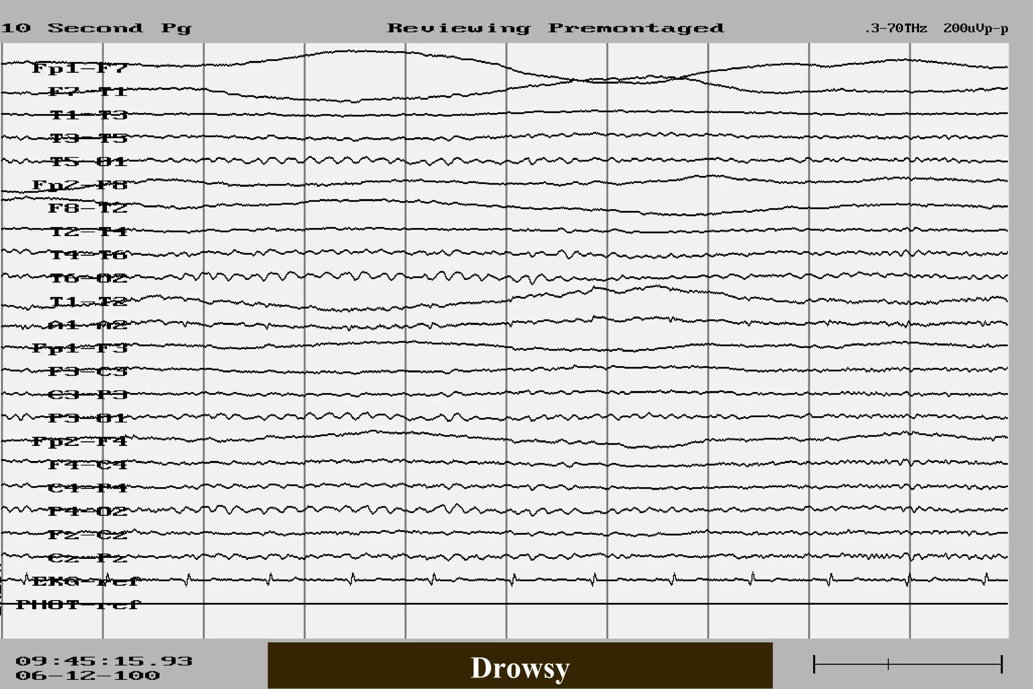Normal EEG patterns, frequencies, as well as patterns that may simulate ...