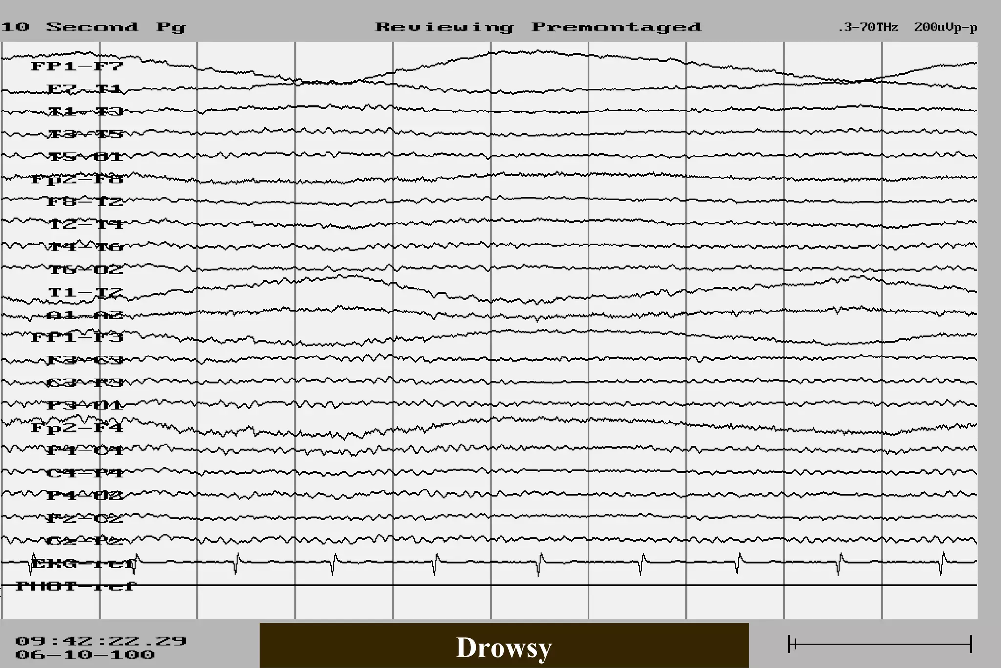 Normal EEG patterns, frequencies, as well as patterns that may simulate ...