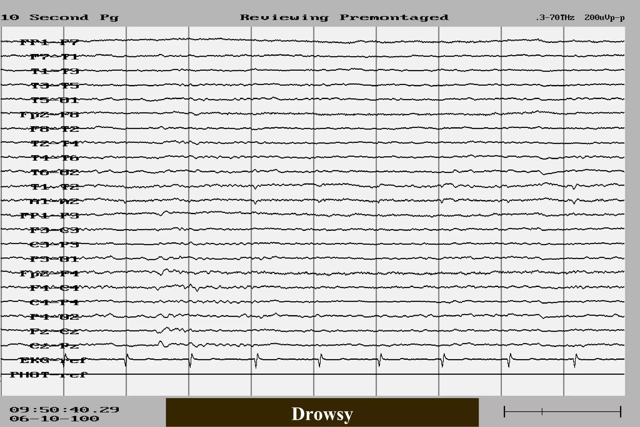 Normal EEG patterns, frequencies, as well as patterns that may simulate ...