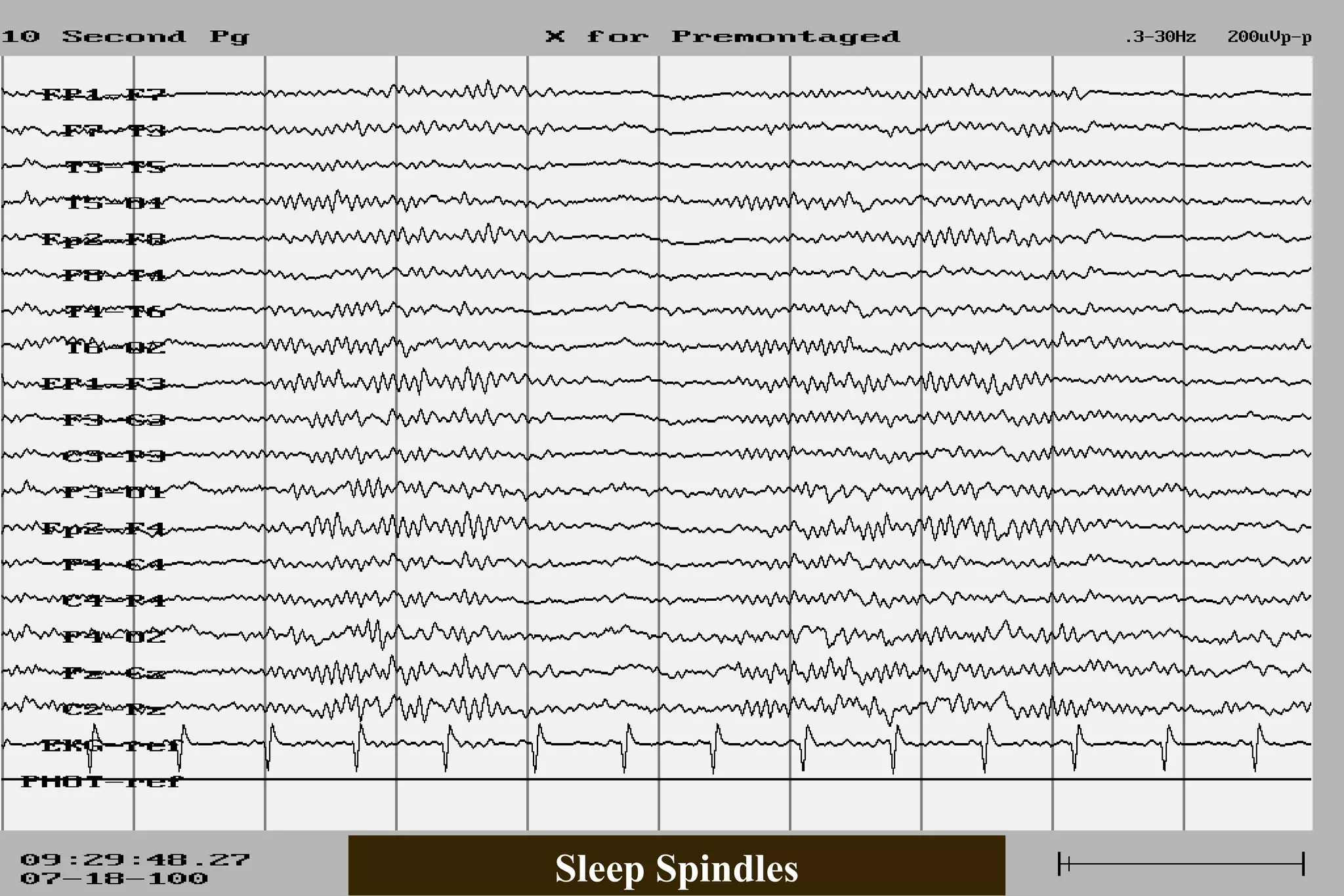 Normal EEG patterns, frequencies, as well as patterns that may simulate ...