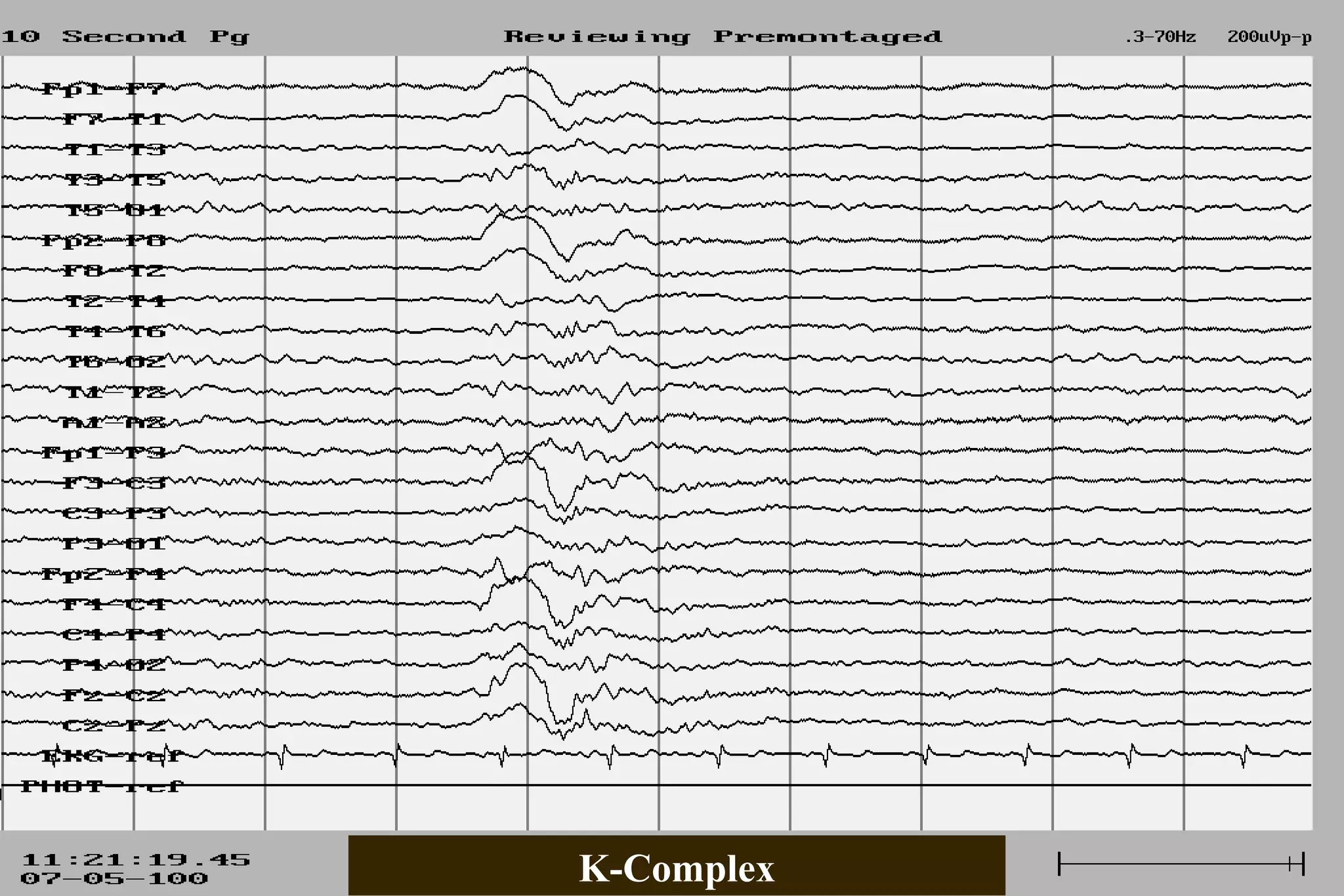 Normal EEG patterns, frequencies, as well as patterns that may simulate ...
