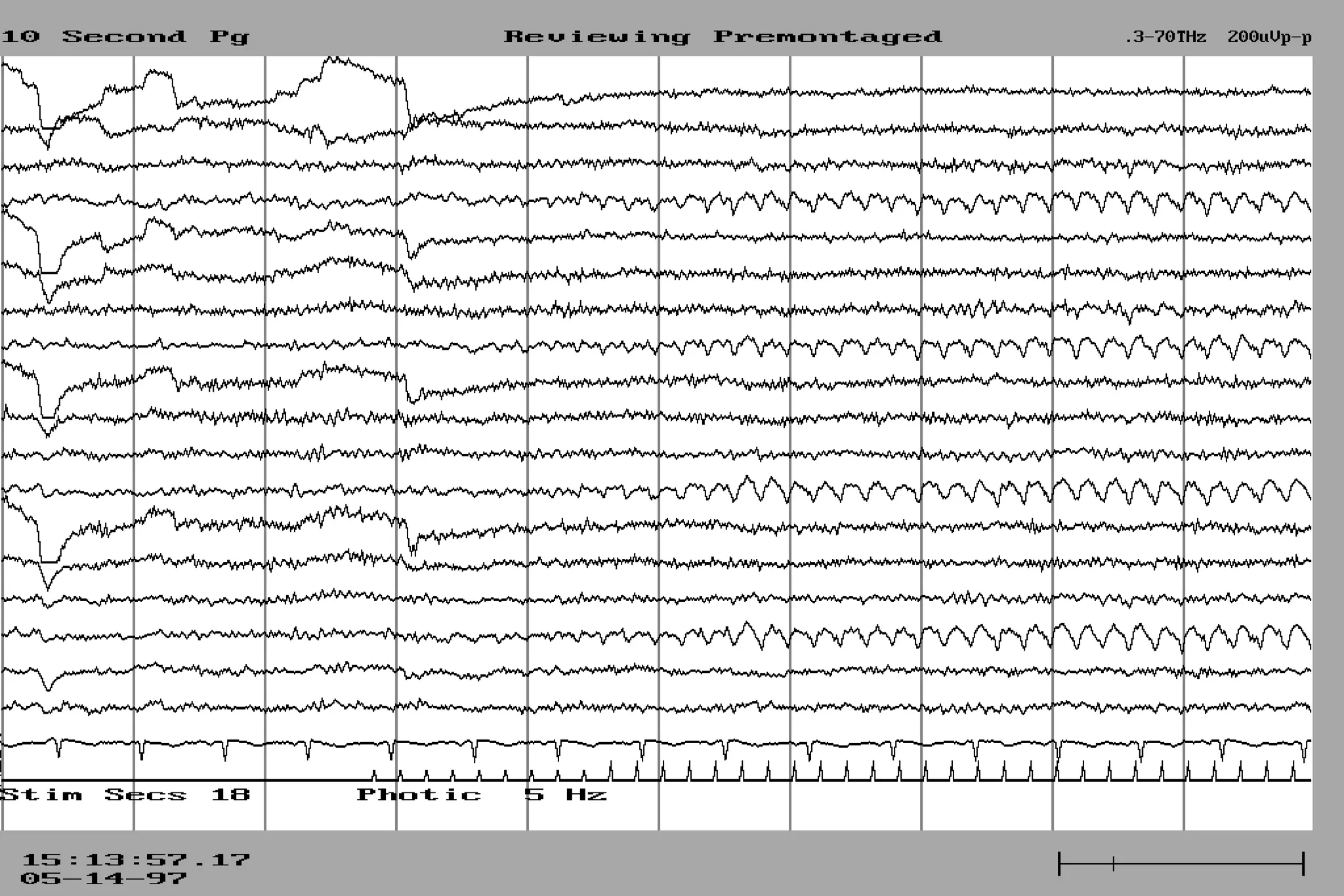 Normal EEG patterns, frequencies, as well as patterns that may simulate ...