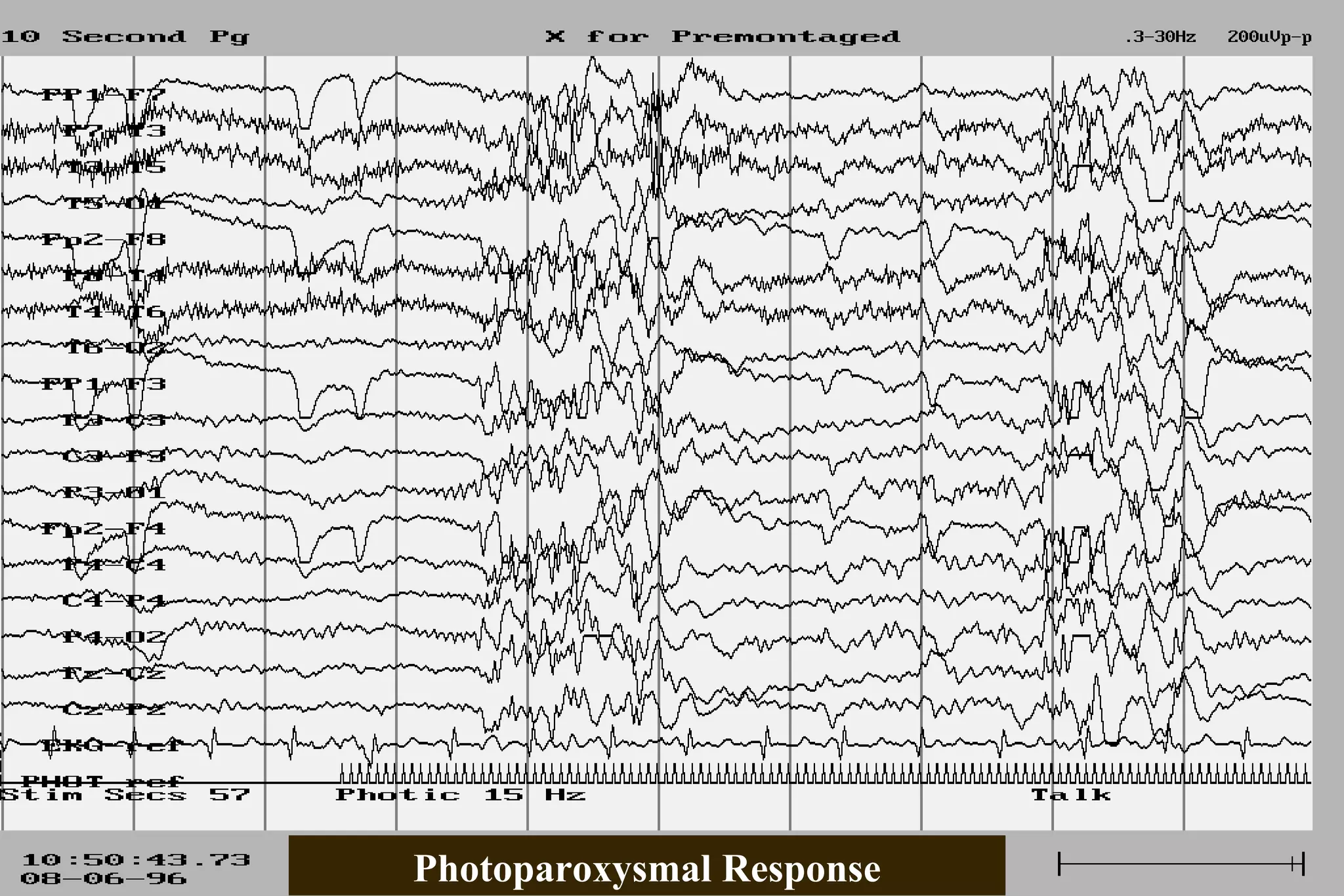 Normal EEG patterns, frequencies, as well as patterns that may simulate ...