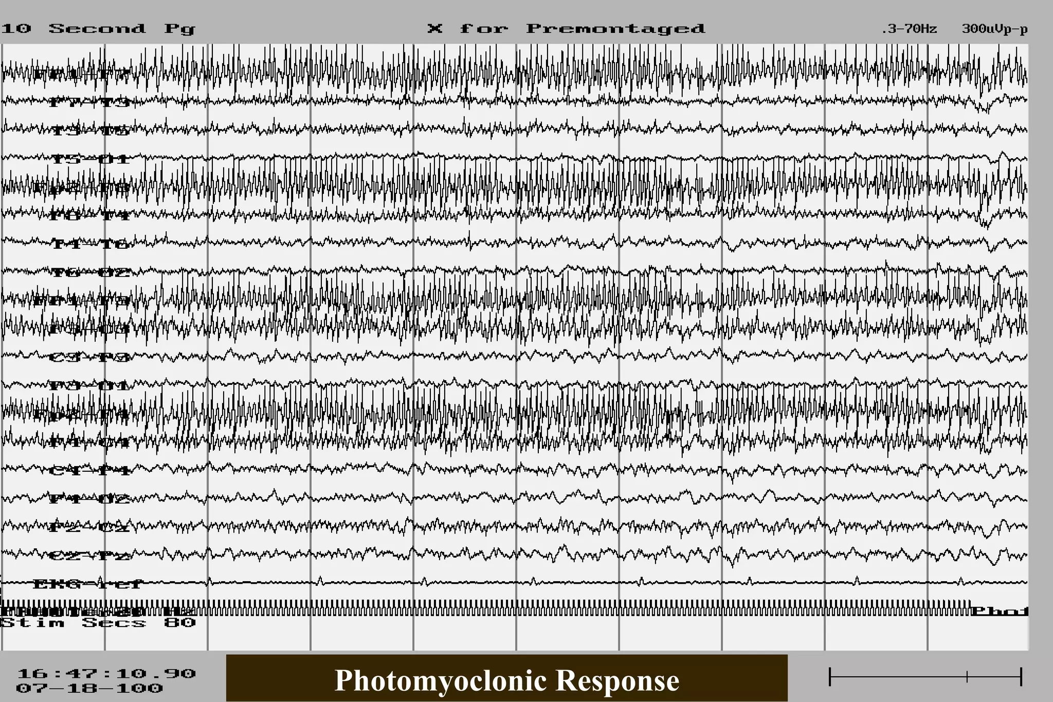 Normal EEG patterns, frequencies, as well as patterns that may simulate ...