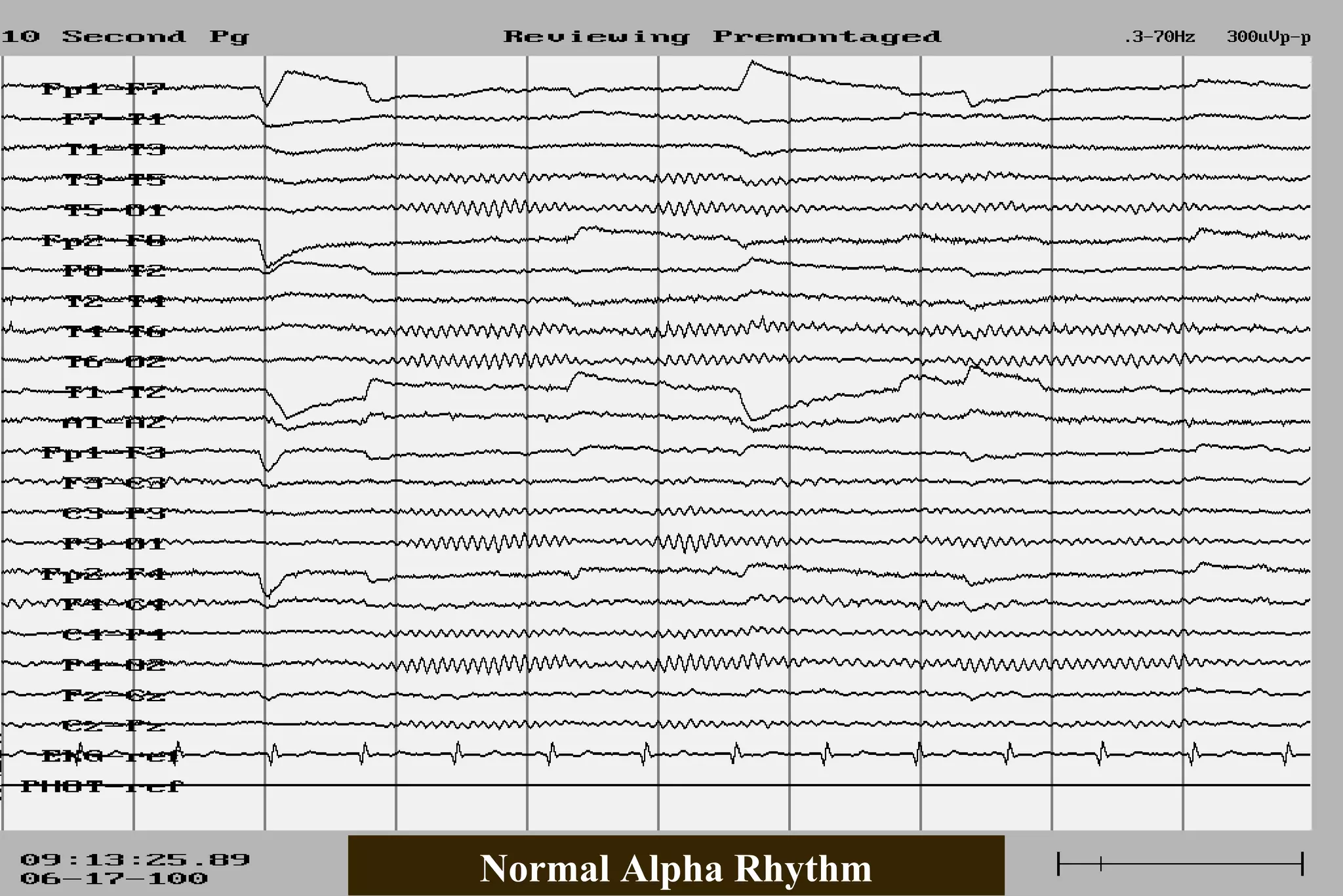 Normal EEG patterns, frequencies, as well as patterns that may simulate ...
