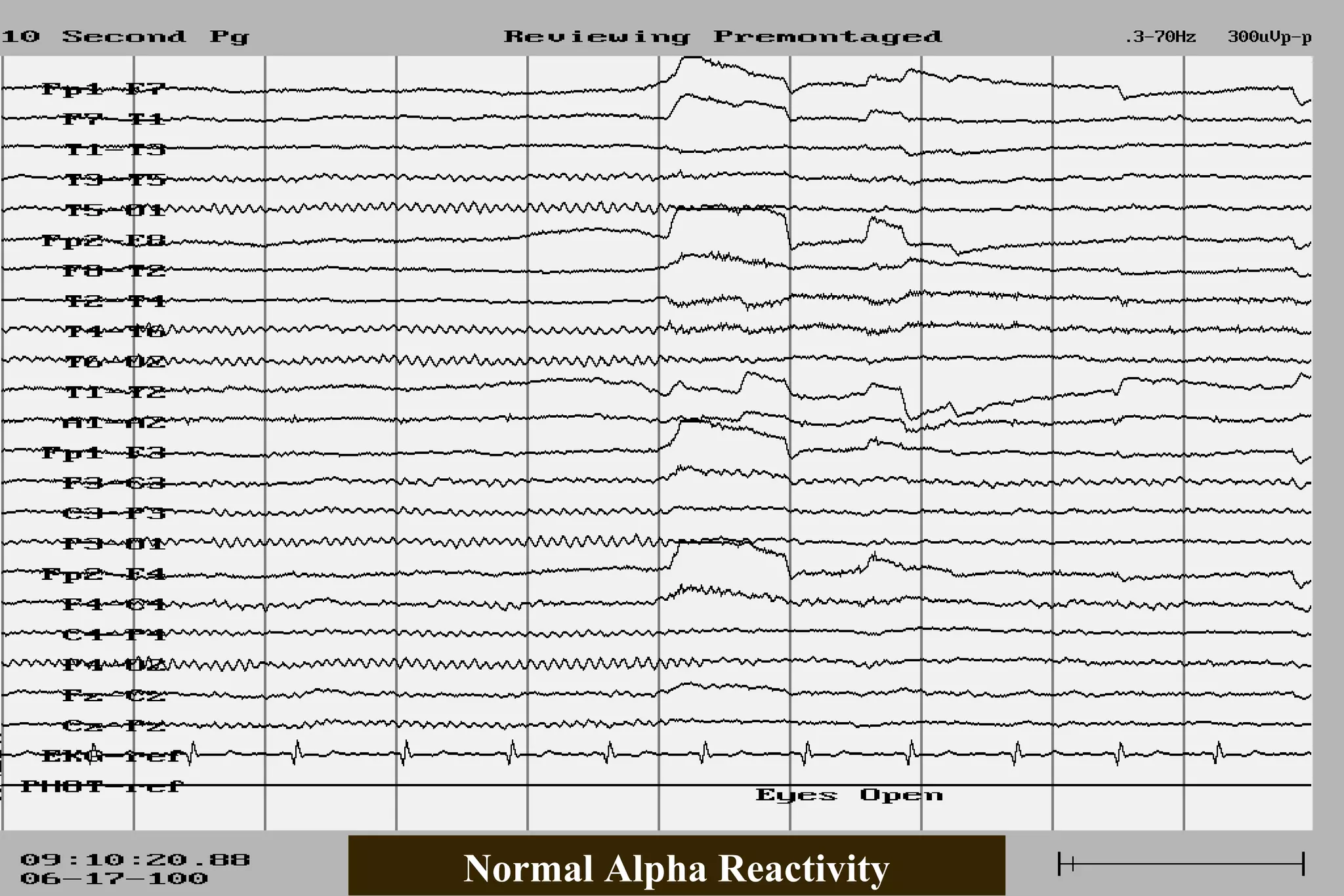 Normal EEG patterns, frequencies, as well as patterns that may simulate ...
