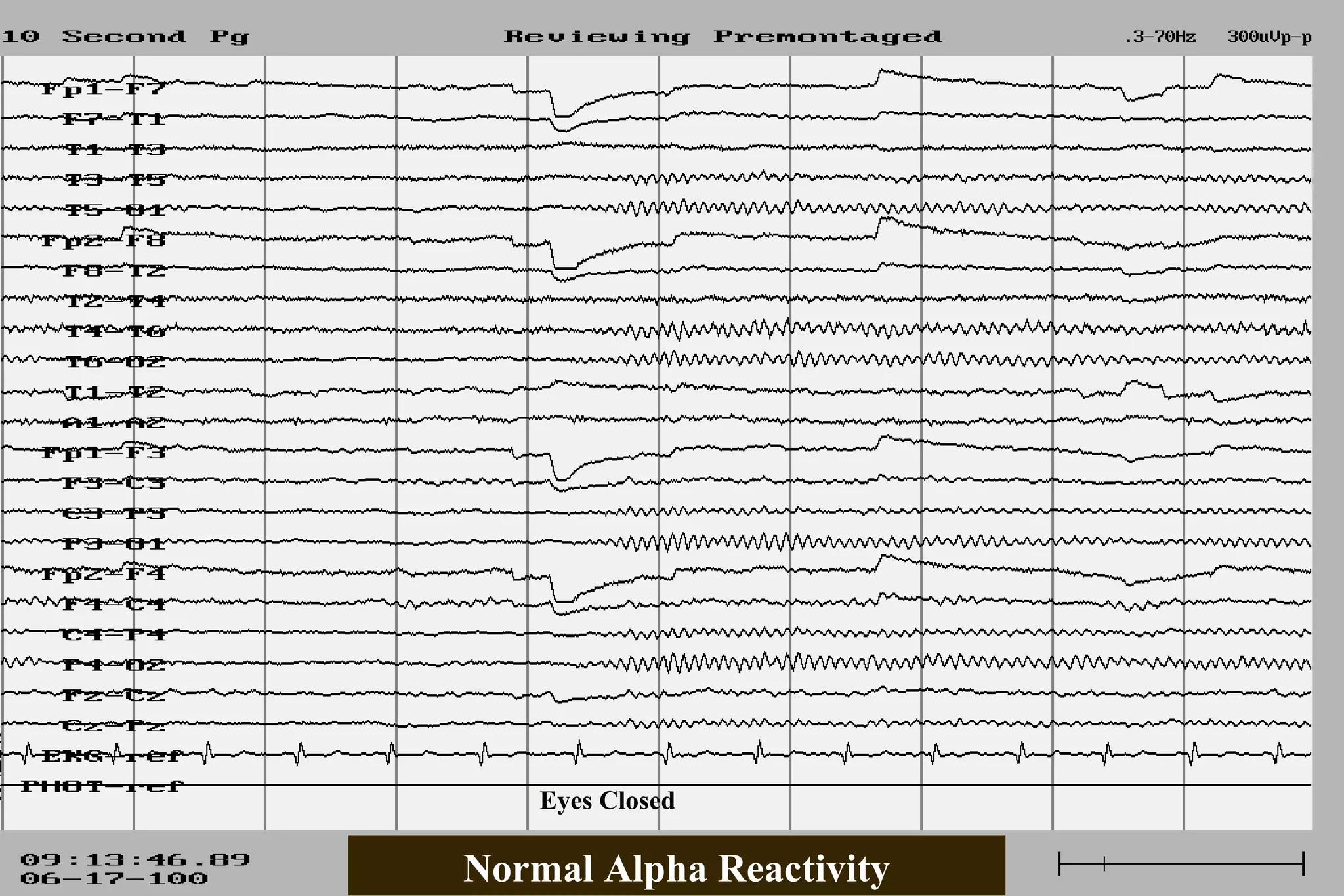 Normal EEG patterns, frequencies, as well as patterns that may simulate ...