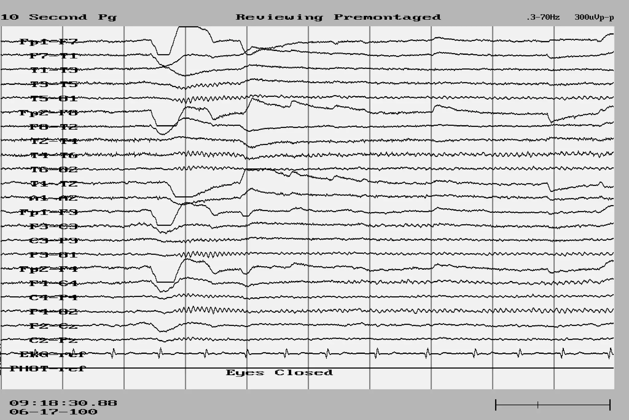 Normal EEG patterns, frequencies, as well as patterns that may simulate ...