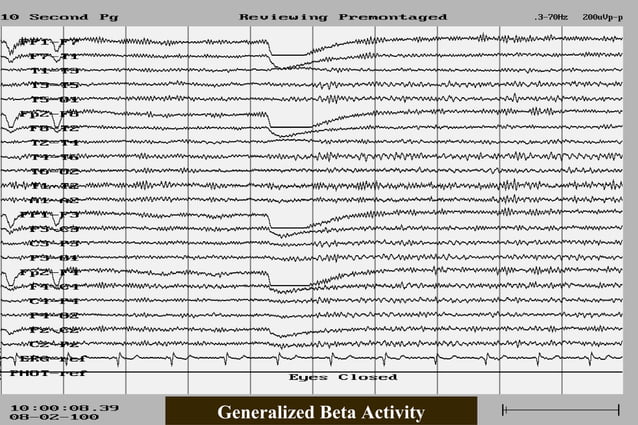 Normal EEG patterns, frequencies, as well as patterns that may simulate ...