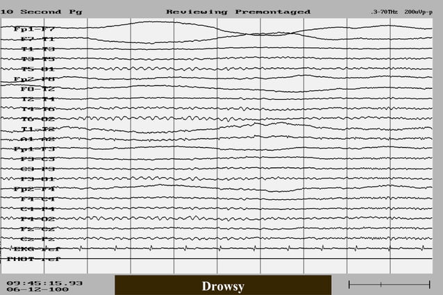Normal EEG patterns, frequencies, as well as patterns that may simulate ...