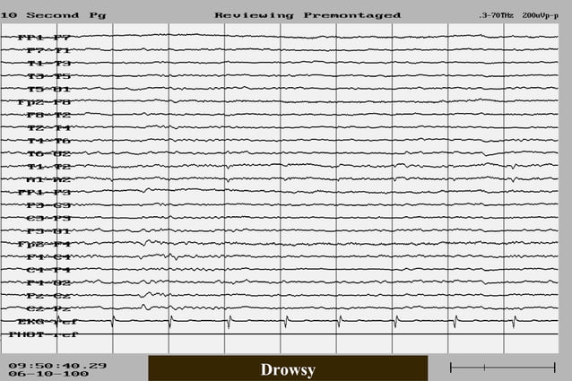 Normal EEG patterns, frequencies, as well as patterns that may simulate ...