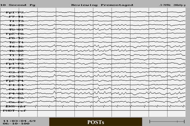 Normal EEG patterns, frequencies, as well as patterns that may simulate ...