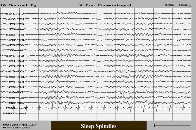 Normal EEG patterns, frequencies, as well as patterns that may simulate ...