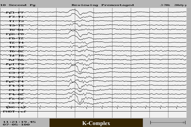 Normal EEG patterns, frequencies, as well as patterns that may simulate ...