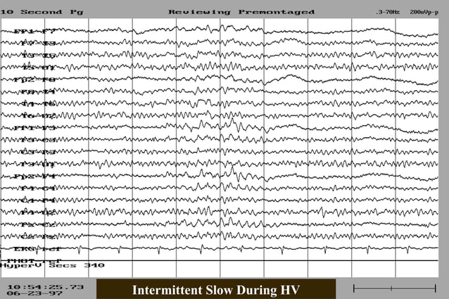 Normal EEG patterns, frequencies, as well as patterns that may simulate ...