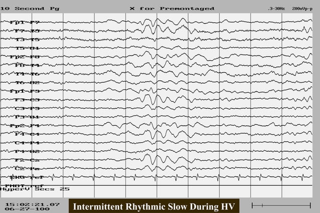 Normal EEG patterns, frequencies, as well as patterns that may simulate ...