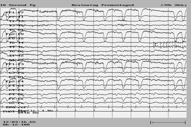 Normal EEG patterns, frequencies, as well as patterns that may simulate ...