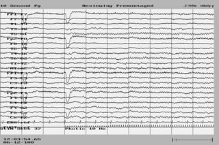 Normal EEG patterns, frequencies, as well as patterns that may simulate ...