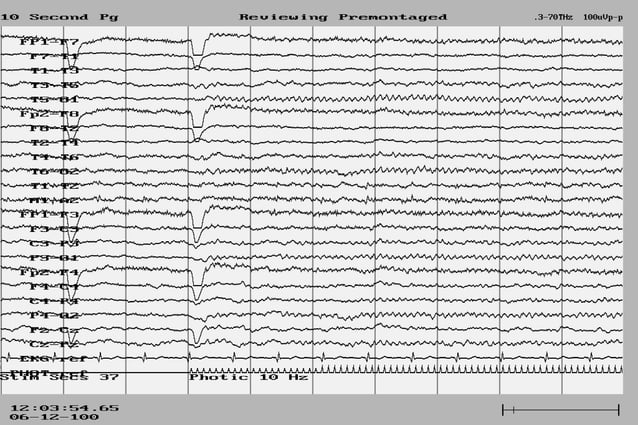 Normal EEG patterns, frequencies, as well as patterns that may simulate ...