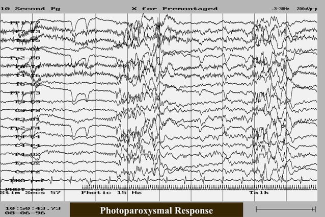 Normal EEG patterns, frequencies, as well as patterns that may simulate ...