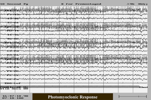Normal EEG patterns, frequencies, as well as patterns that may simulate ...