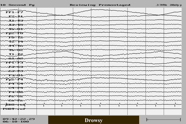 Normal EEG patterns, frequencies, as well as patterns that may simulate ...