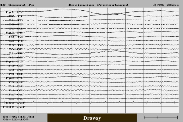 Normal EEG patterns, frequencies, as well as patterns that may simula…