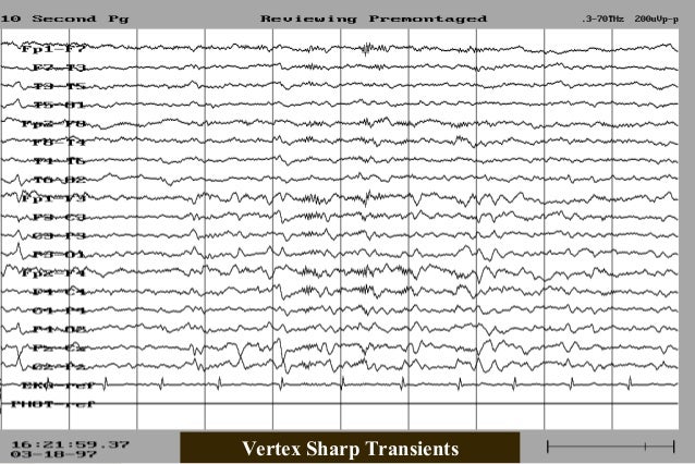 Normal EEG patterns, frequencies, as well as patterns that may simula…