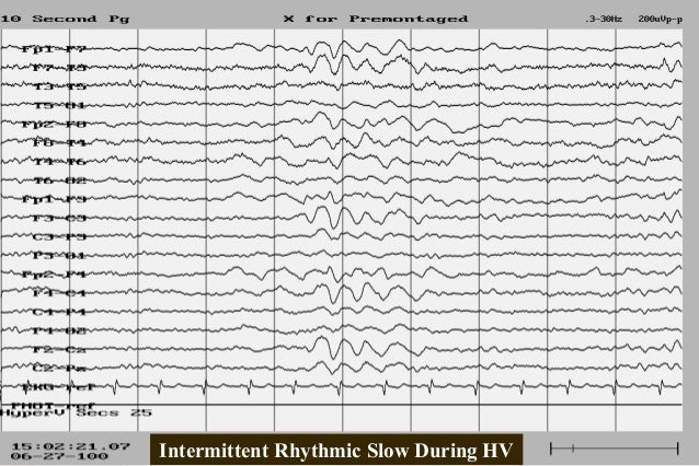 Normal EEG patterns, frequencies, as well as patterns that may simula…