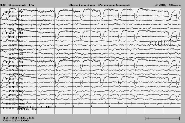 Normal Eeg Patterns Frequencies As Well As Patterns That May Simula