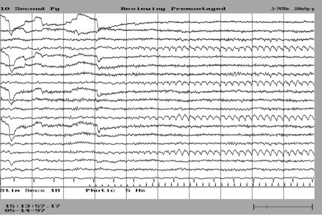 Normal EEG patterns, frequencies, as well as patterns that may simula…