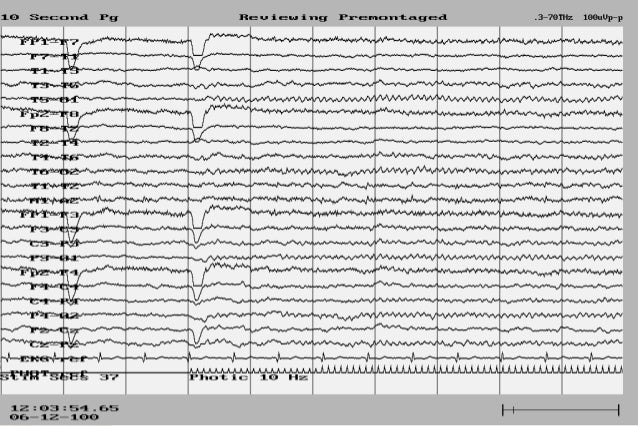 Normal EEG patterns, frequencies, as well as patterns that may simula…