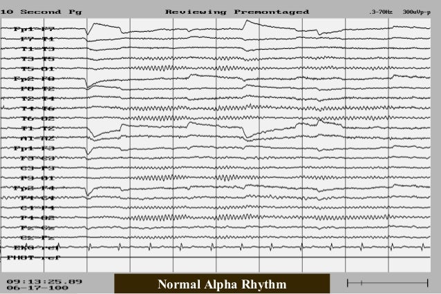 Normal EEG patterns, frequencies, as well as patterns that may simula…