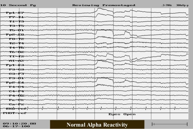 Normal EEG patterns, frequencies, as well as patterns that may simula…