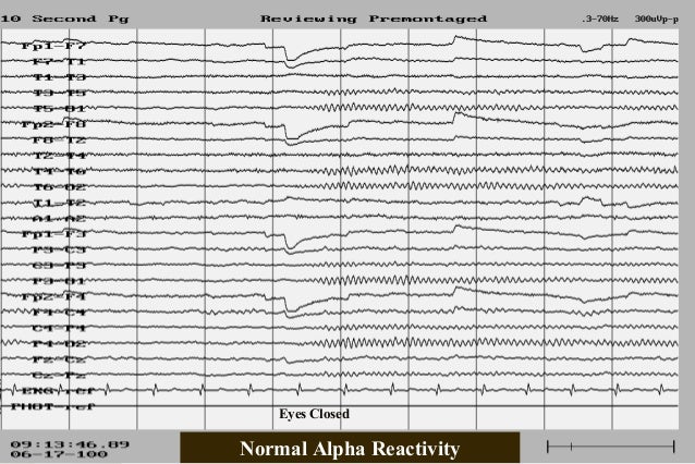 Normal EEG patterns, frequencies, as well as patterns that may simula…