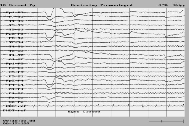 Normal EEG patterns, frequencies, as well as patterns that may simula…