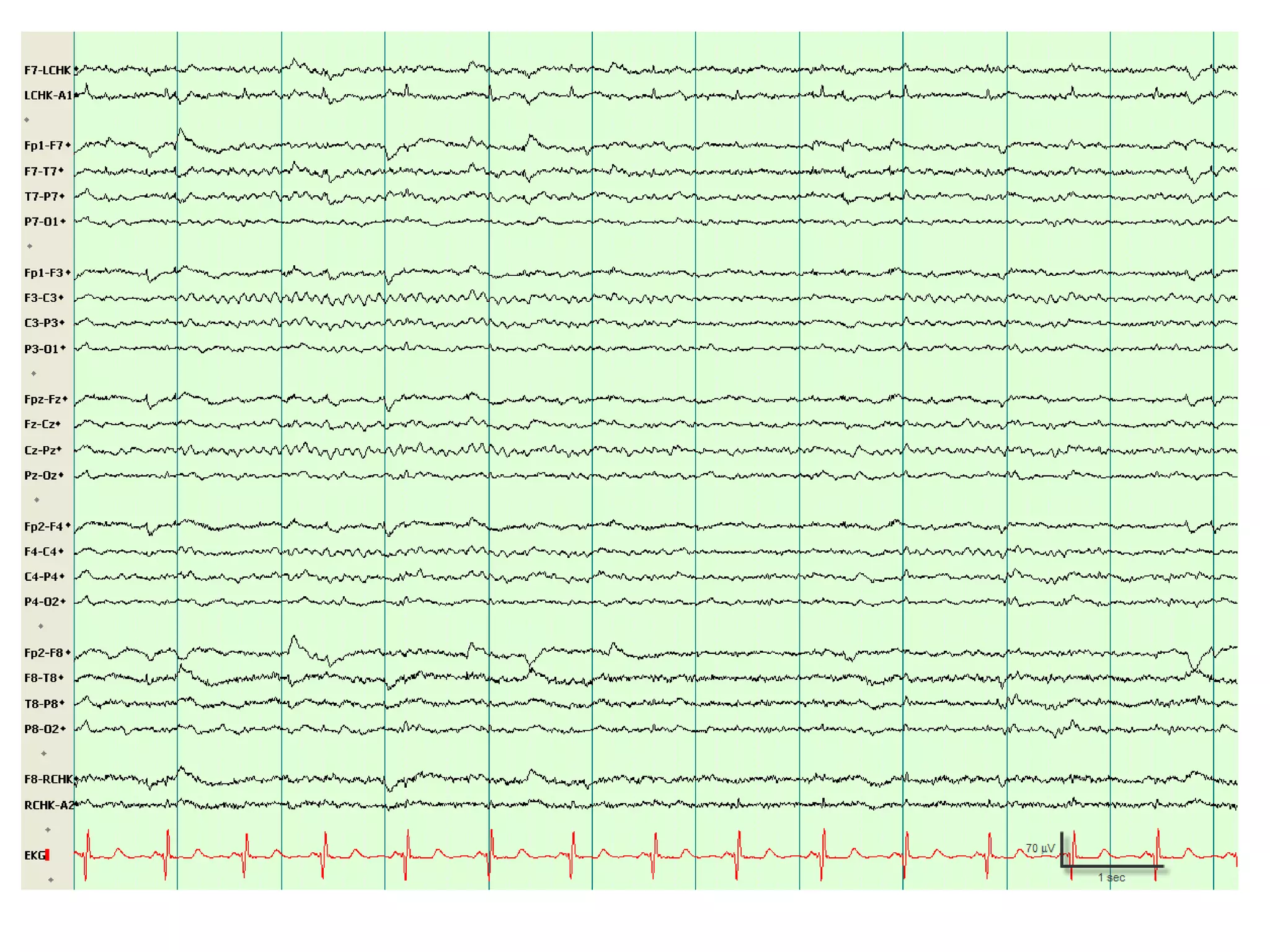 EEG Variants with patterns by Murtaza Syed | PPT