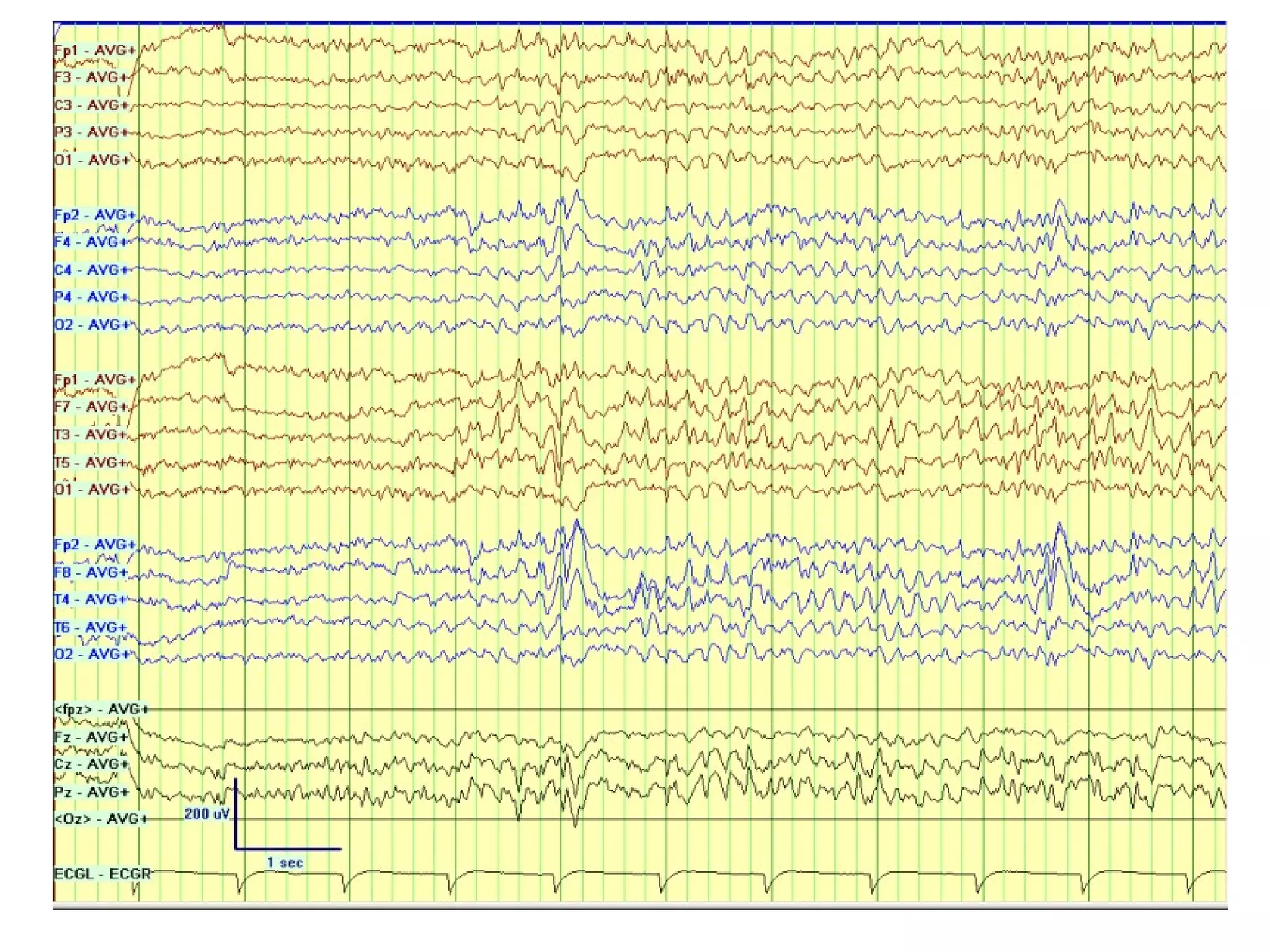 EEG Variants with patterns by Murtaza Syed | PPT | Brain and Nervous ...