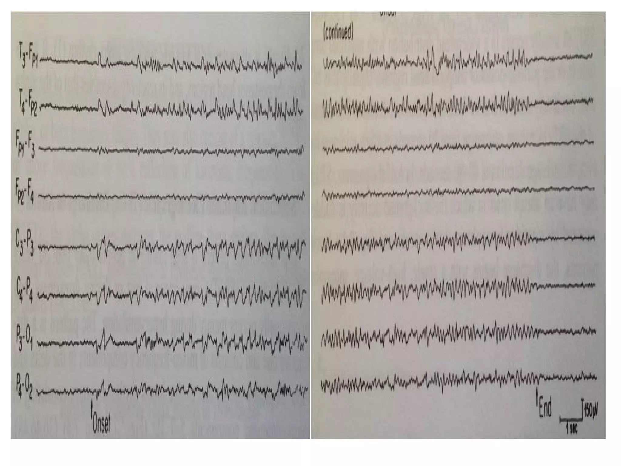 EEG Variants with patterns by Murtaza Syed | PPT
