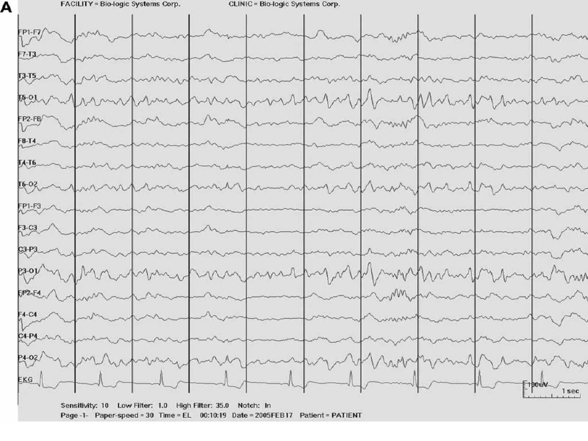 EEG Variants with patterns by Murtaza Syed | PPT | Brain and Nervous ...