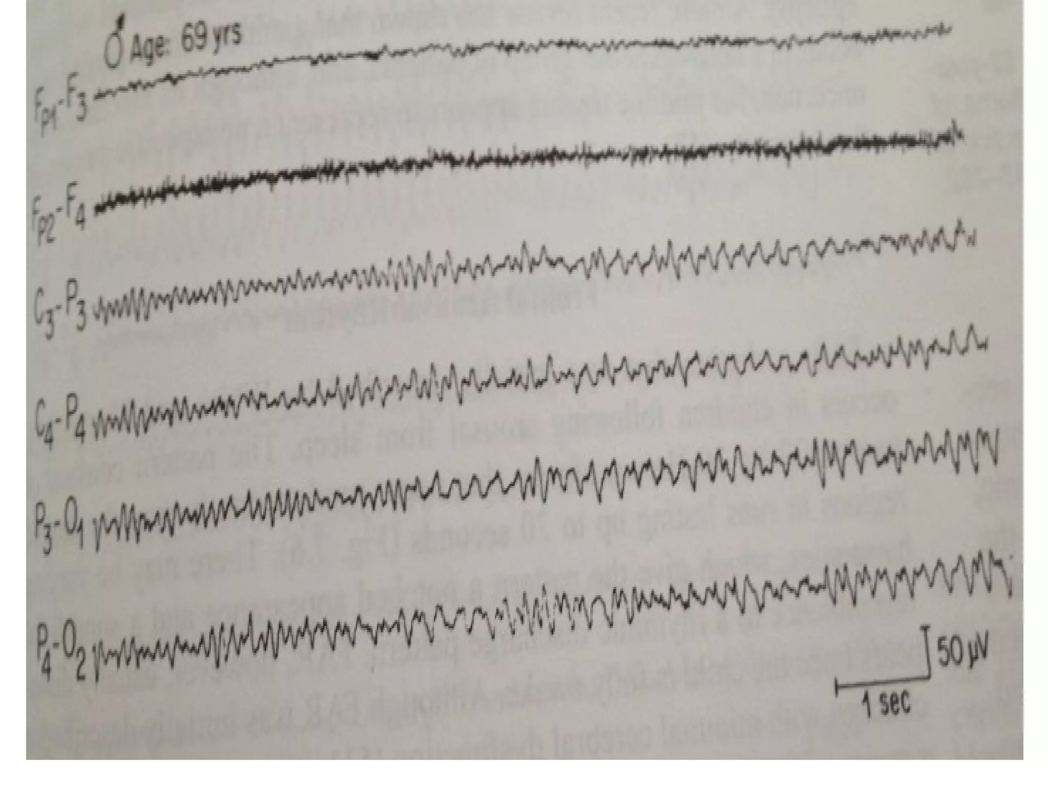 EEG Variants with patterns by Murtaza Syed | PPT