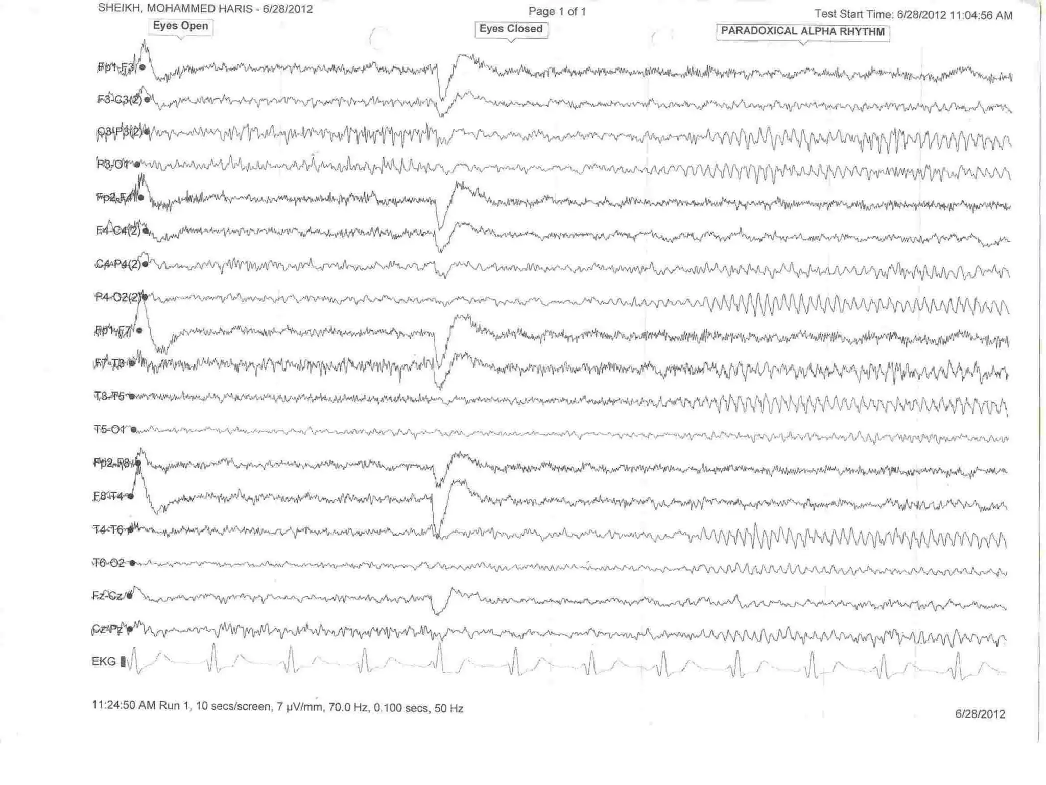 EEG Variants with patterns by Murtaza Syed | PPT | Brain and Nervous ...