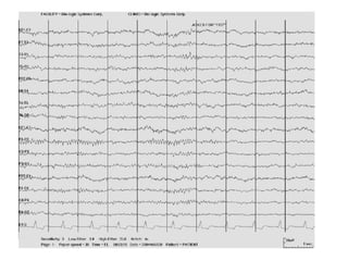 EEG Variants with patterns by Murtaza Syed | PPT
